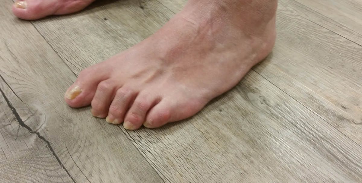 Hammerzehe, Krallenzehe - Dr.-medic Manuel Nastai