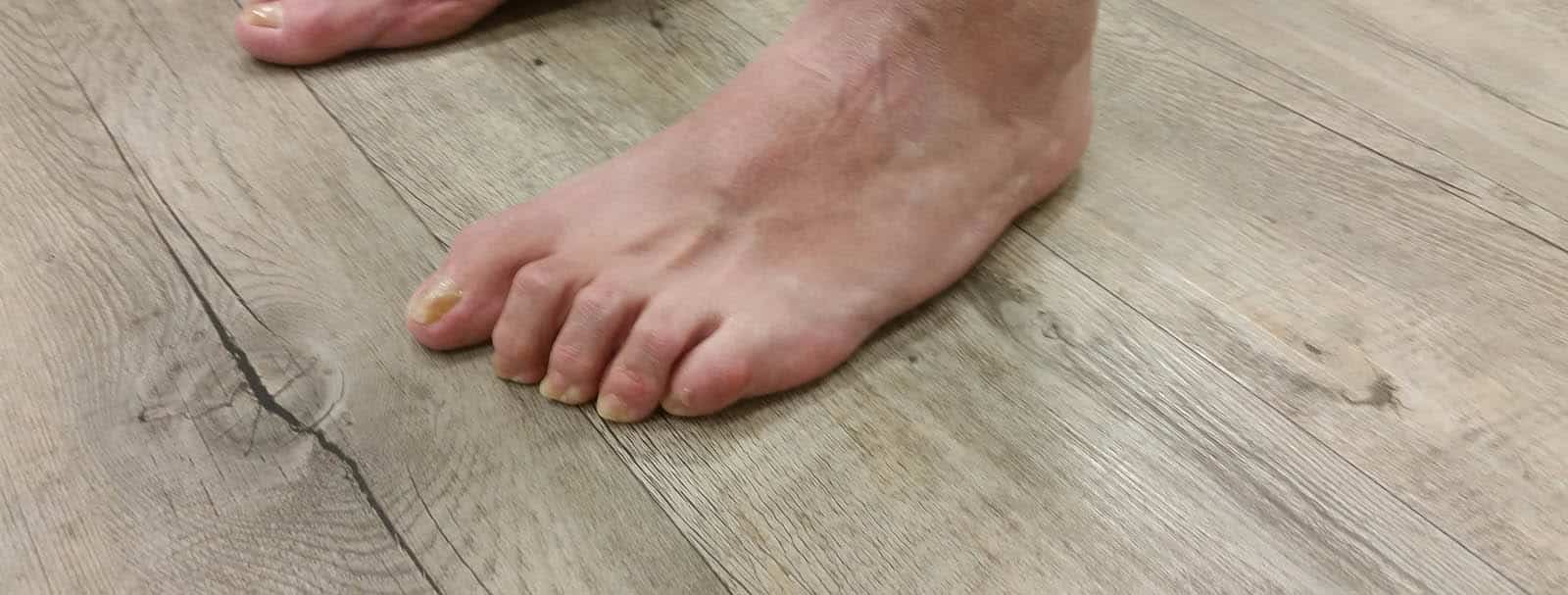 Hammerzehe, Krallenzehe - Dr.-medic Manuel Nastai