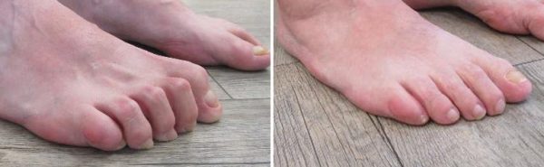 Hammerzehe, Krallenzehe - Dr.-medic Manuel Nastai