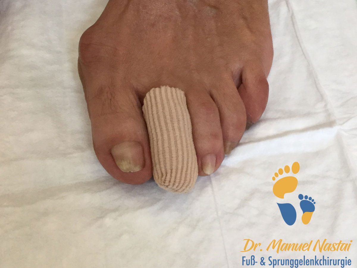 Hammerzehe, Krallenzehe - Dr.-medic Manuel Nastai