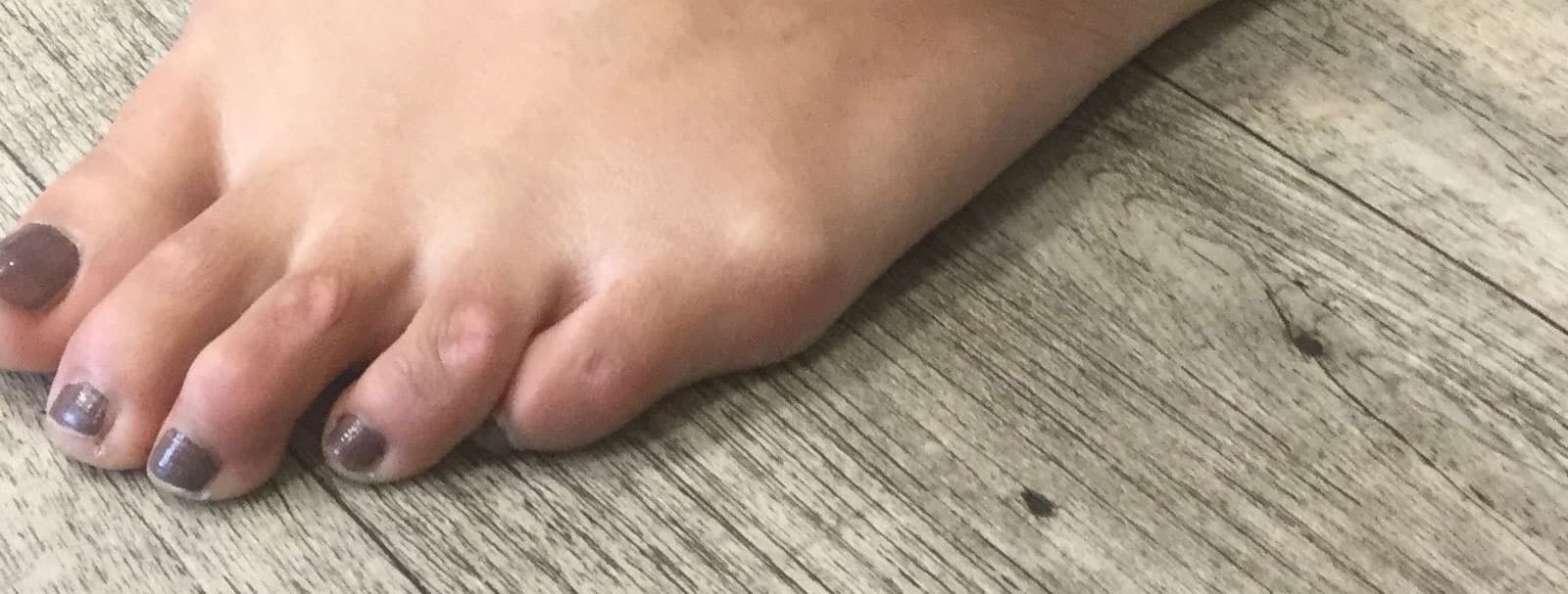 Schneiderballen (Digitus quintus varus) - Dr.-medic Manuel Nastai