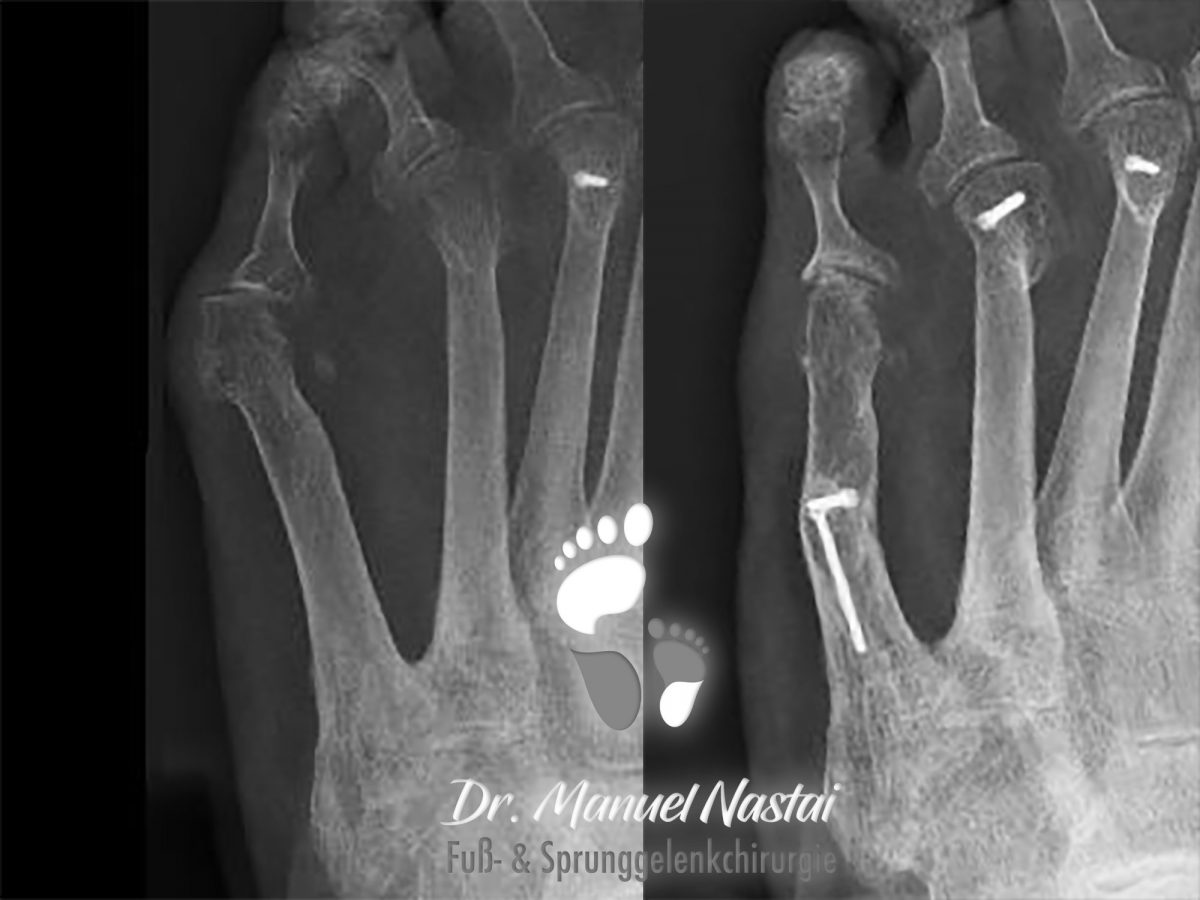 Schneiderballen (Digitus quintus varus) - Dr.-medic Manuel Nastai