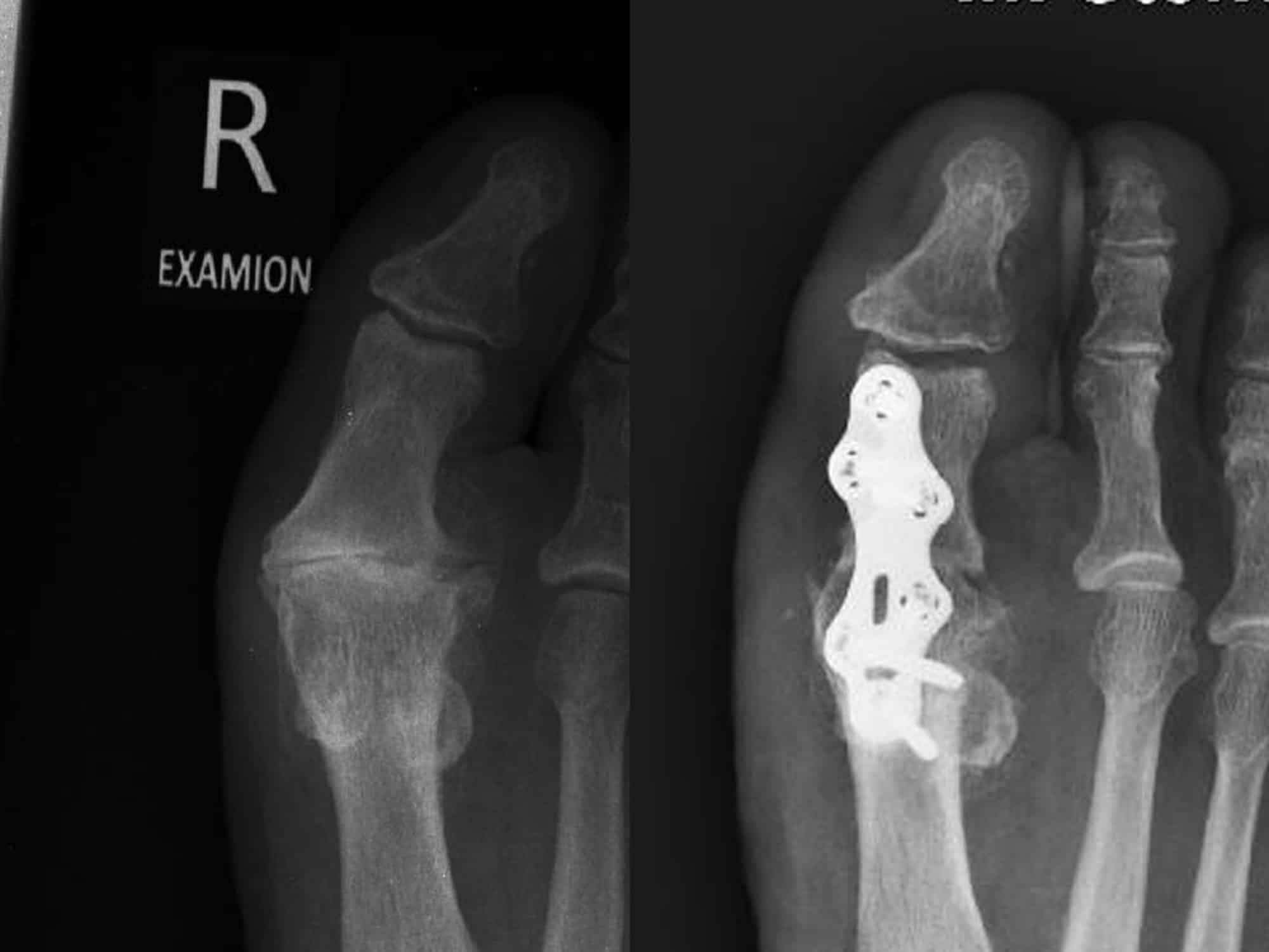 Hallux rigidus - Dr. Manuel Nastai | Fuß- und Sprunggelenkschirurgie