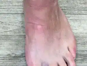 Fußarthrose - Dr.-medic Manuel Nastai | Fußchirurgie