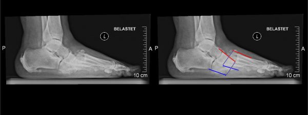 Charcot-Fuß | Charcot-Arthropathie | DNOAP