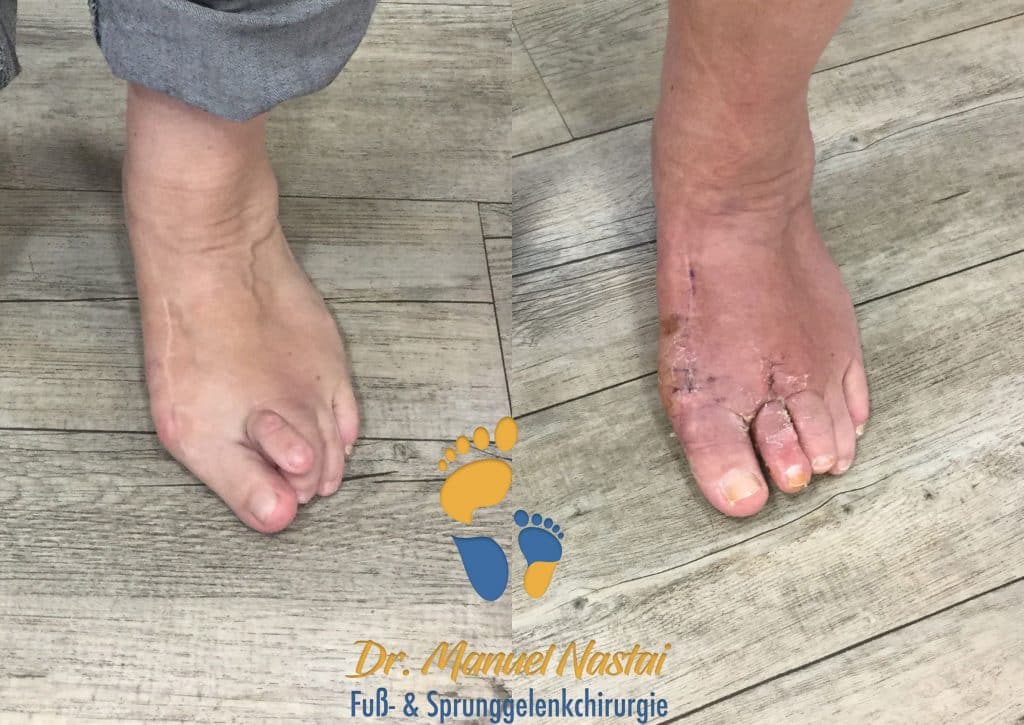 Reiterzehe (Digitus secundus superductus) - Dr. Manuel Nastai | Fuß ...