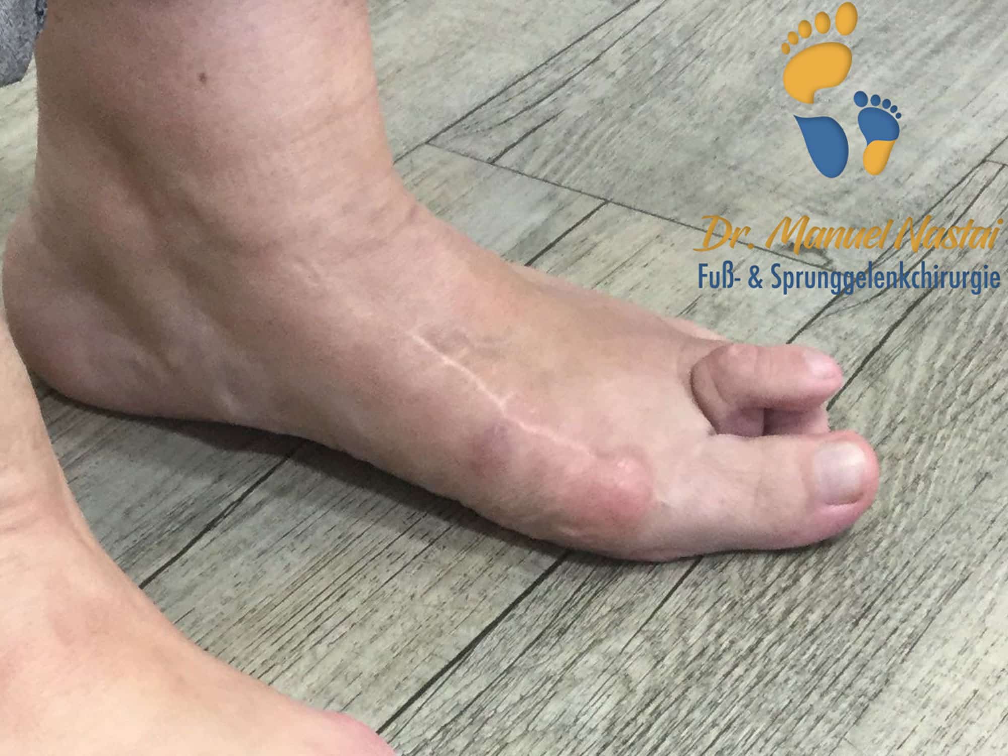 Minimalinvasive Reiterzehe-Korrektur - Dr.-medic Manuel Nastai