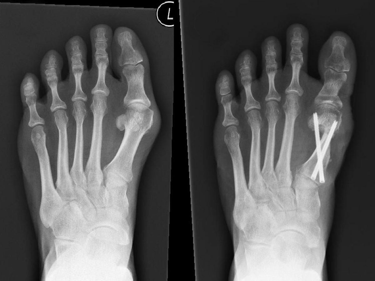 Minimalinvasive Chevron-/Akin-Osteotomie (MICA) - Dr.-medic Manuel Nastai