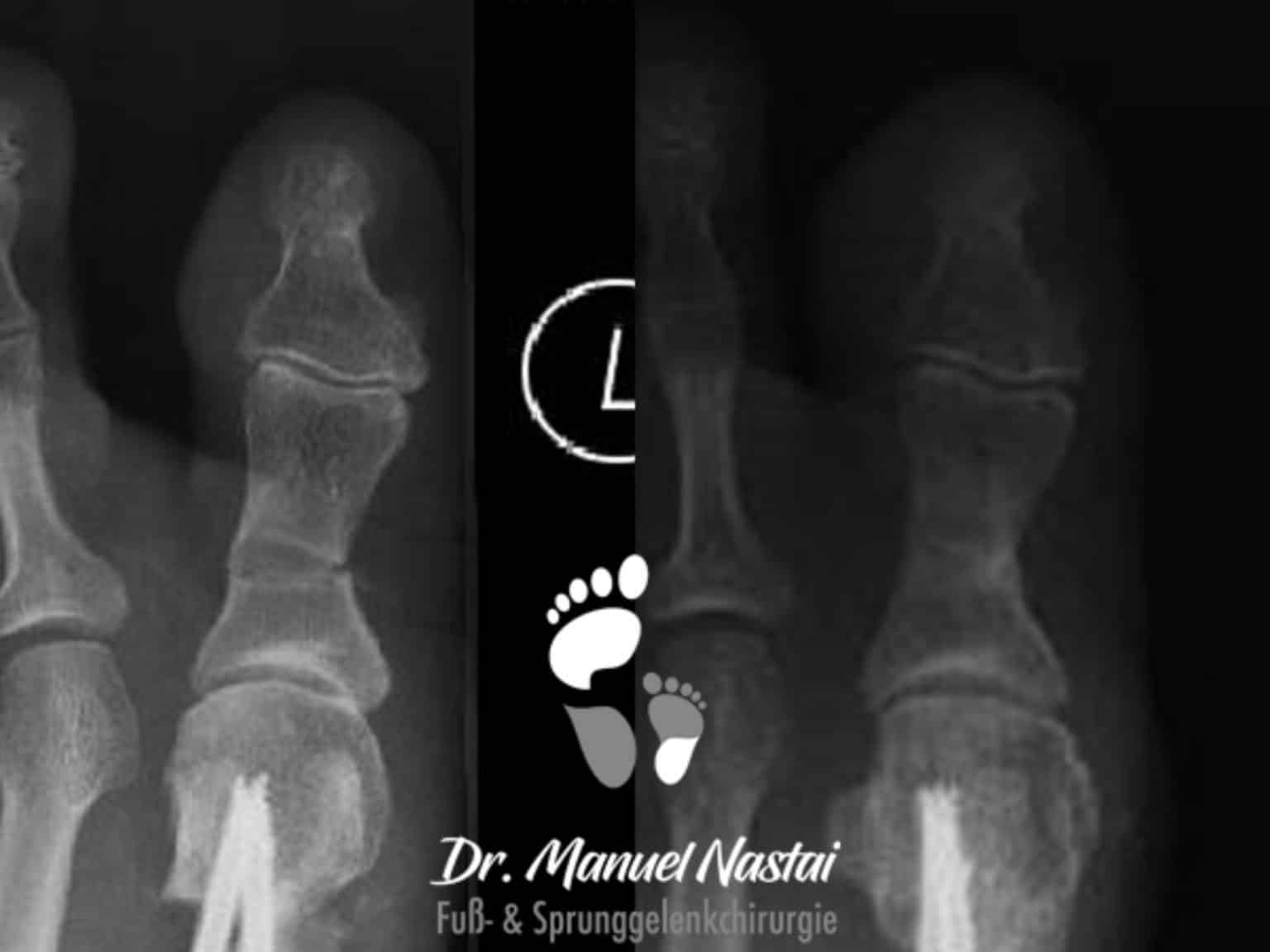 Minimalinvasive Chevron-/Akin-Osteotomie (MICA) - Dr.-medic Manuel Nastai