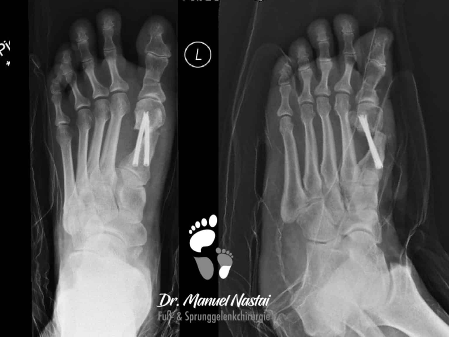 Minimalinvasive Chevron-/Akin-Osteotomie (MICA) - Dr.-medic Manuel Nastai