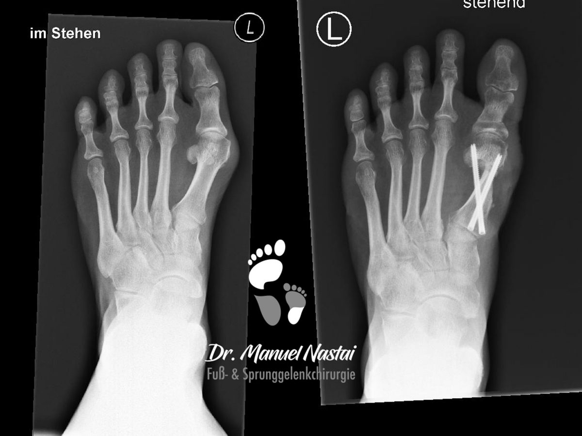 Arbeitsunfähigkeit Nach Hallux Valgus Op – HYSK
