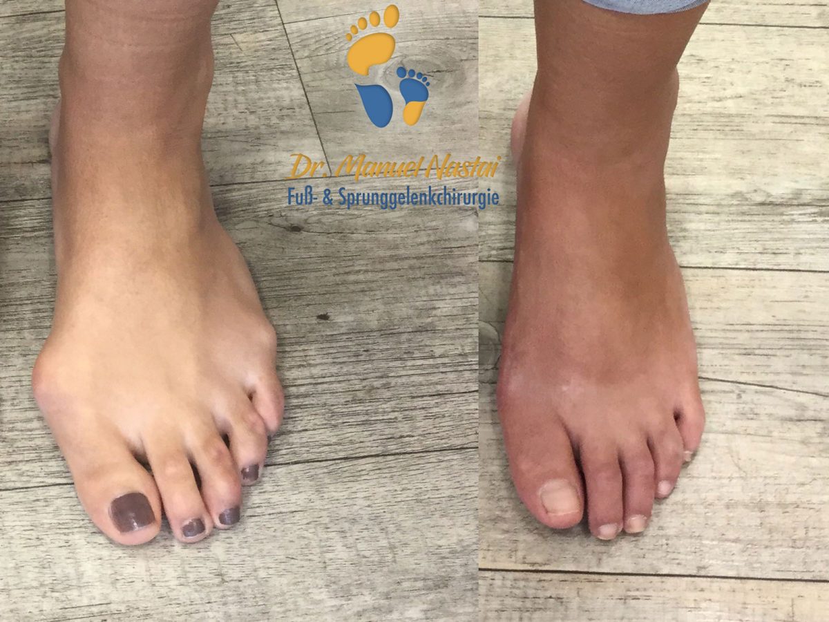 Schneiderballen Op: minimalinvasive Chevronette - Dr. M. Nastai