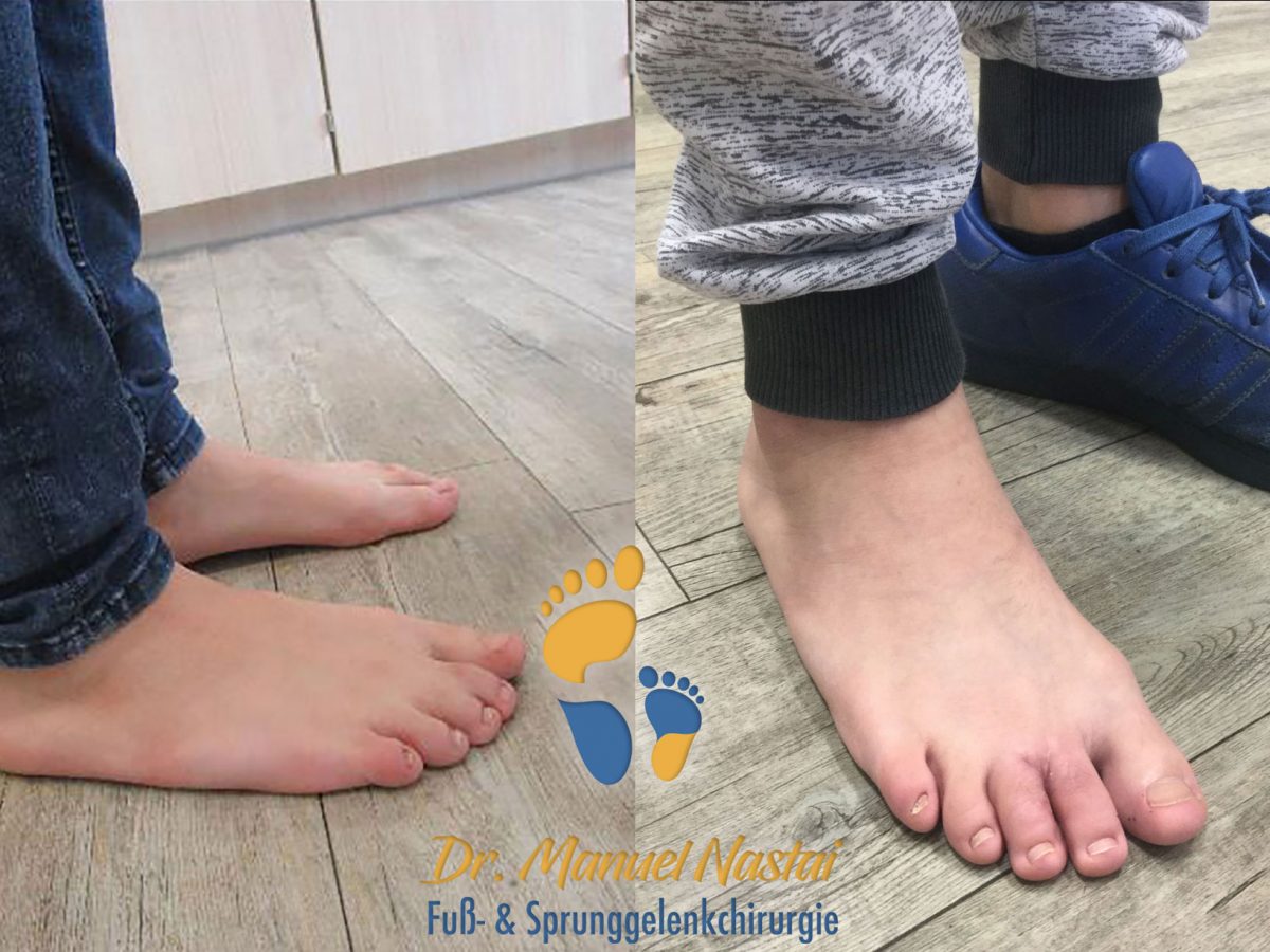 Syndaktylie am Fuß: zusammengewachsene Zehe - Dr.-medic M. Nastai