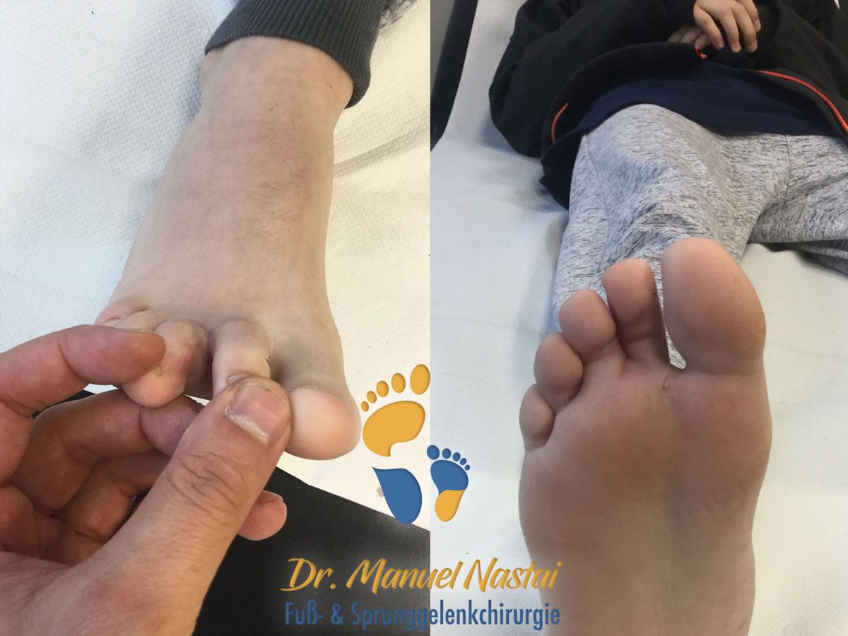 Zehentrennung bei kutaner Syndaktylie - Dr.-medic Manuel Nastai
