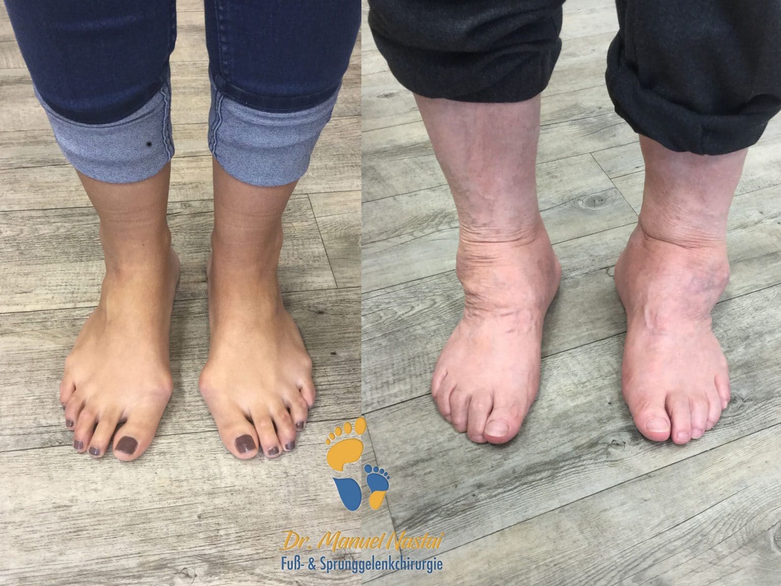 Sprunggelenksarthrose | OSG Verschleiß - Fußspezialist Dr. M. Nastai