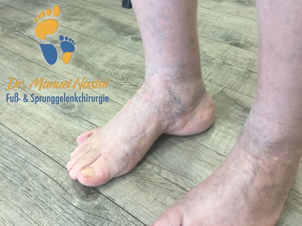 Sprunggelenksarthrose | OSG Verschleiß - Fußspezialist Dr. M. Nastai