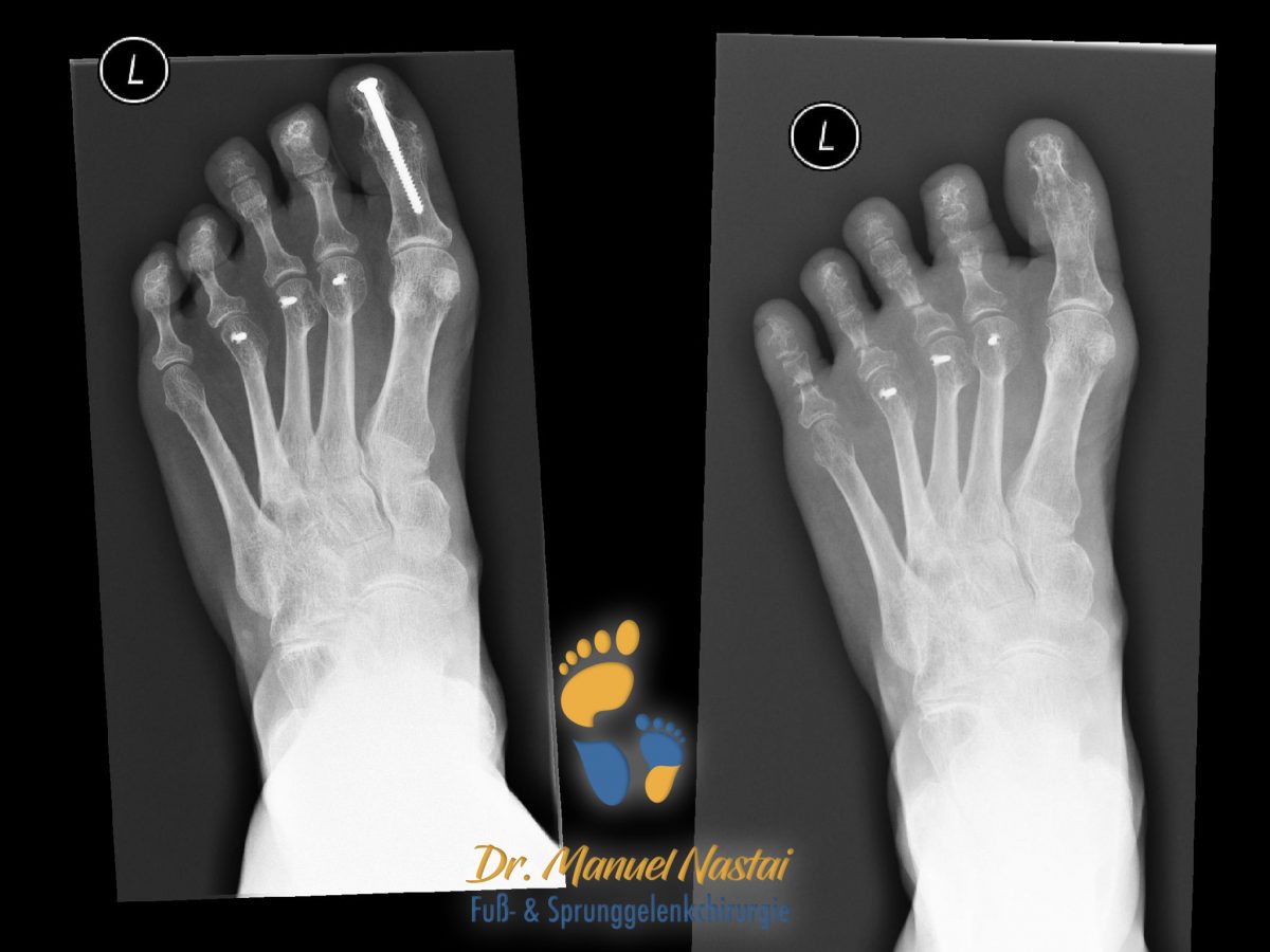 Minimalinvasive Hammerzehenkorrektur - Dr.-medic Manuel Nastai