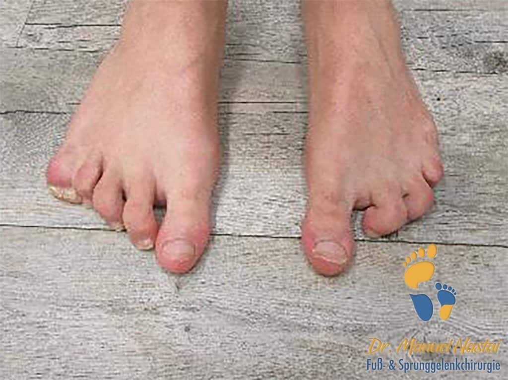 Syndaktylie am Fuß: zusammengewachsene Zehe - Dr.-medic M. Nastai