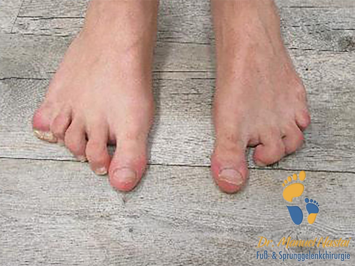 Syndaktylie am Fuß: zusammengewachsene Zehe - Dr.-medic M. Nastai