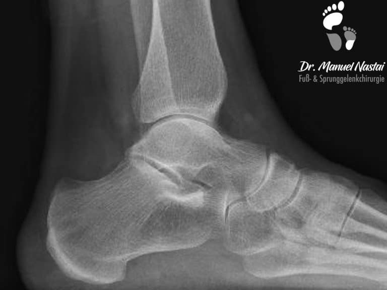 Sprunggelenksarthrose | OSG Verschleiß - Fußspezialist Dr. M. Nastai