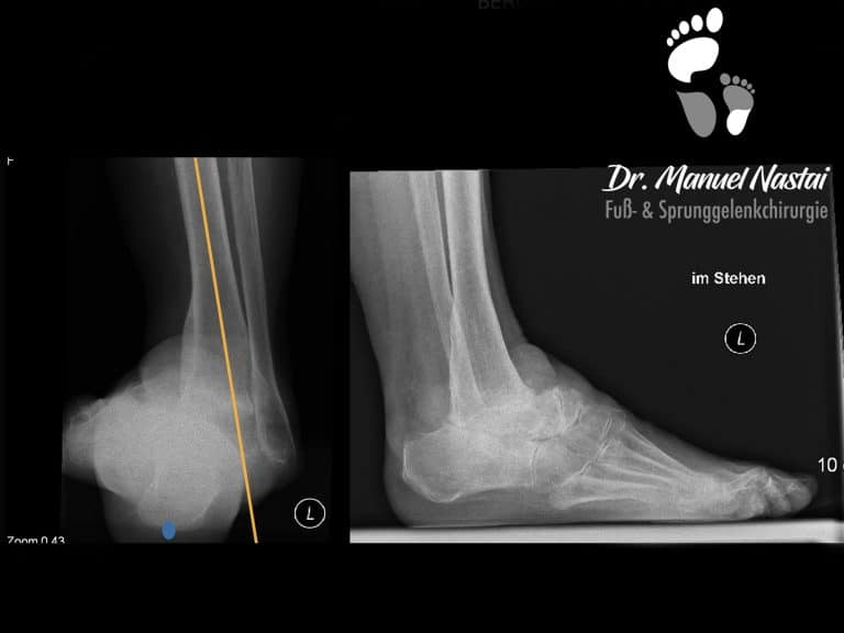 Sprunggelenksarthrose | OSG Verschleiß - Fußspezialist Dr. M. Nastai
