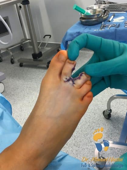 Syndaktylie am Fuß: zusammengewachsene Zehe - Dr.-medic M. Nastai