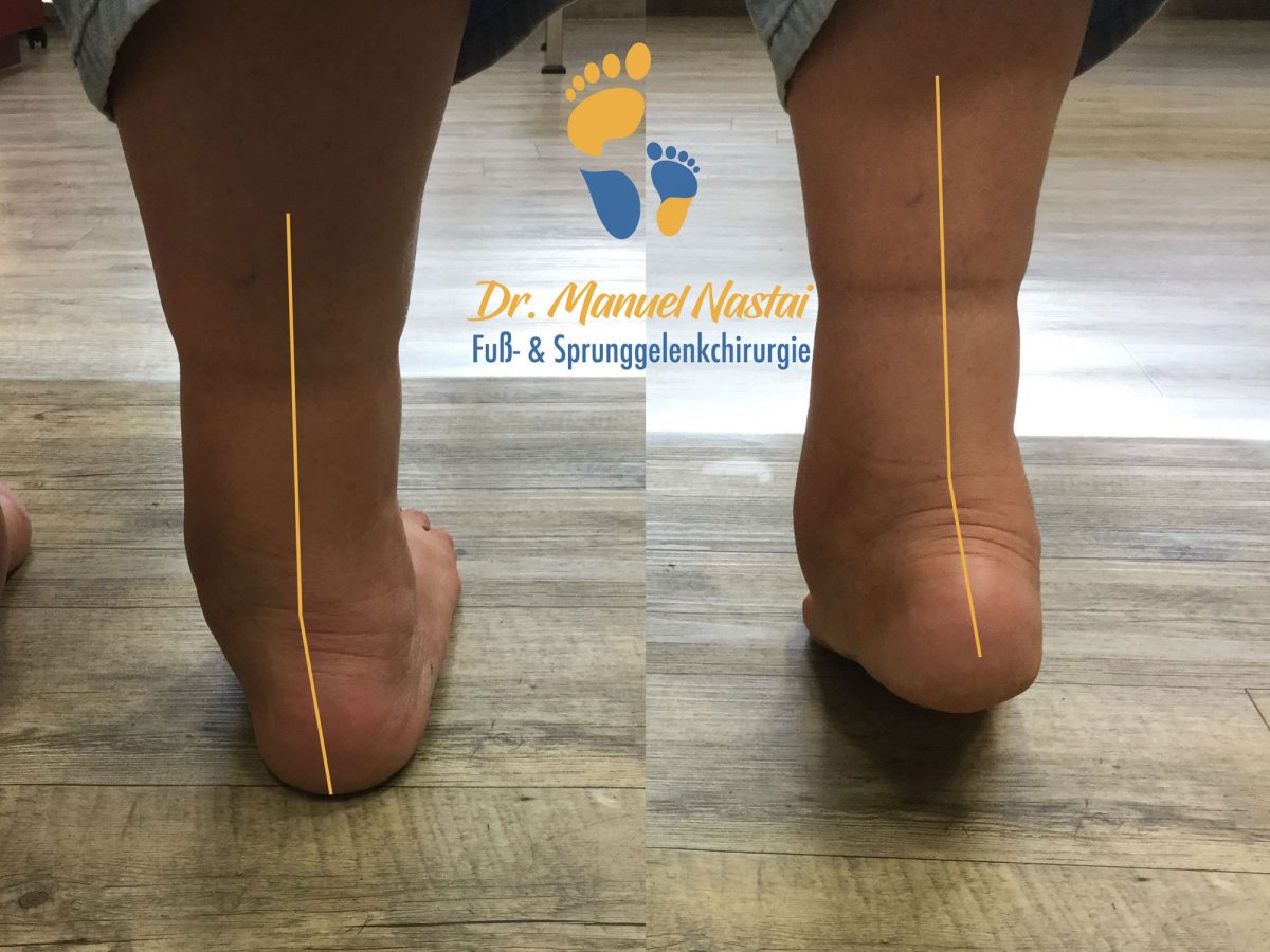 Plattfuß (Pes planovalgus): was ist und was kann man dagegen tun?