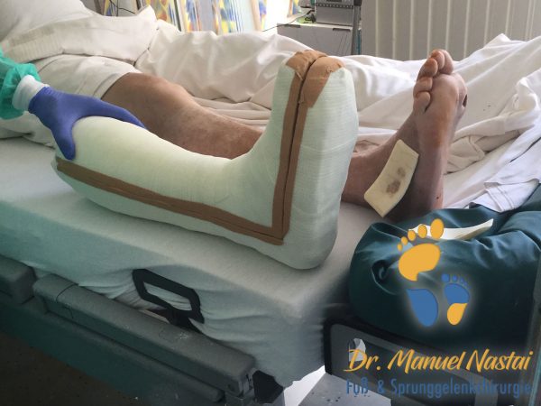 Charcot-Fuß | Charcot-Arthropathie | DNOAP