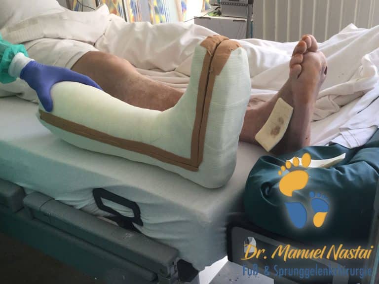 Charcot-Fuß - diabetischer Fuß mit Spontanbrüchen bei Polyneuropathie