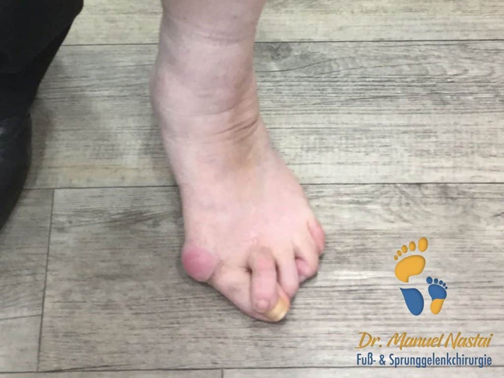 Reiterzehe - Digitus secundus superductus, die überkreuzten Zehen