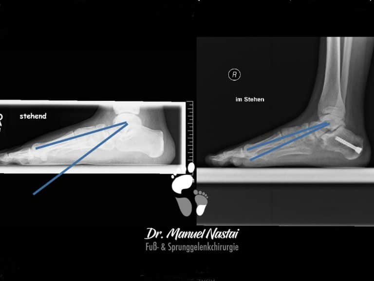 Schmerzhaftes Os tibiale externum - Dr.-medic Manuel Nastai
