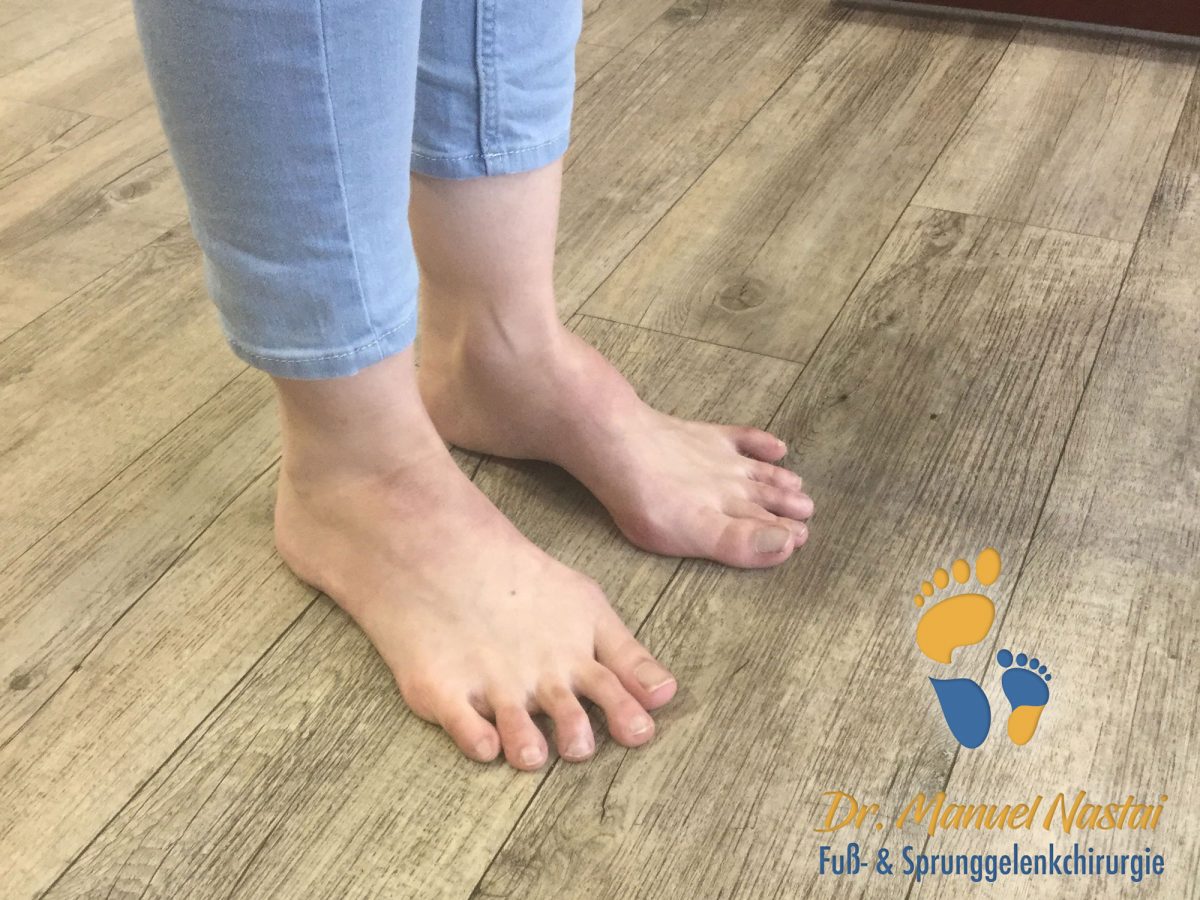Hohlfußkorrektur durch Chopart-Arthrodese - Dr. M. Nastai