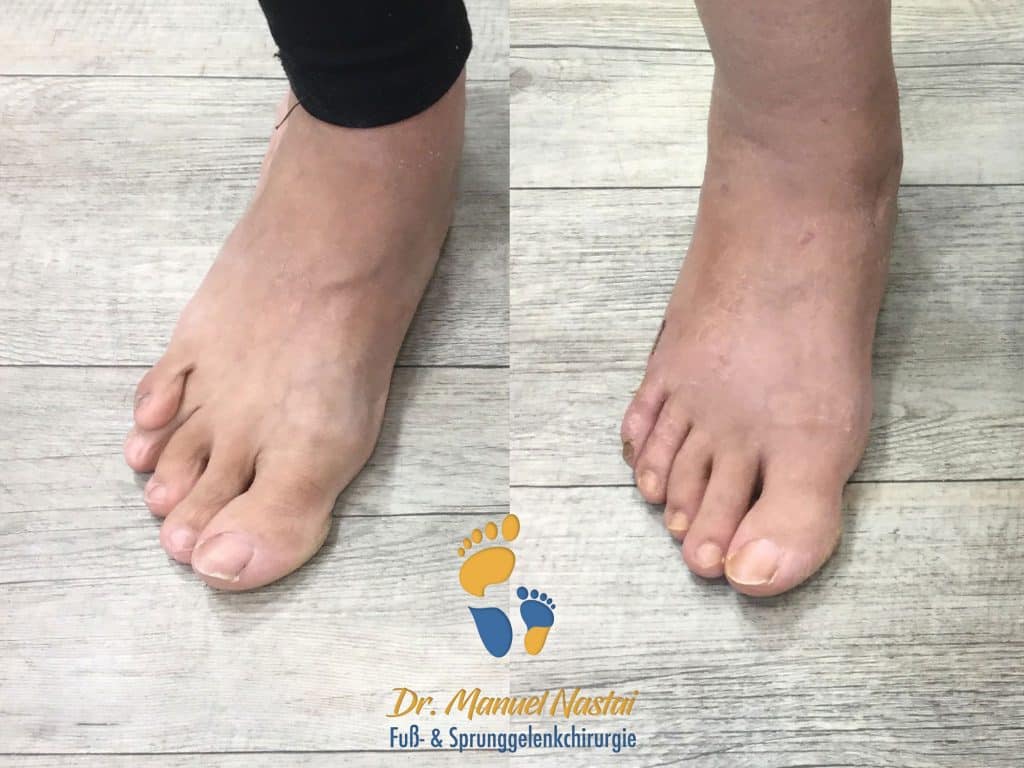 Digitus quintus varus et superductus - Dr.-medic Manuel Nastai