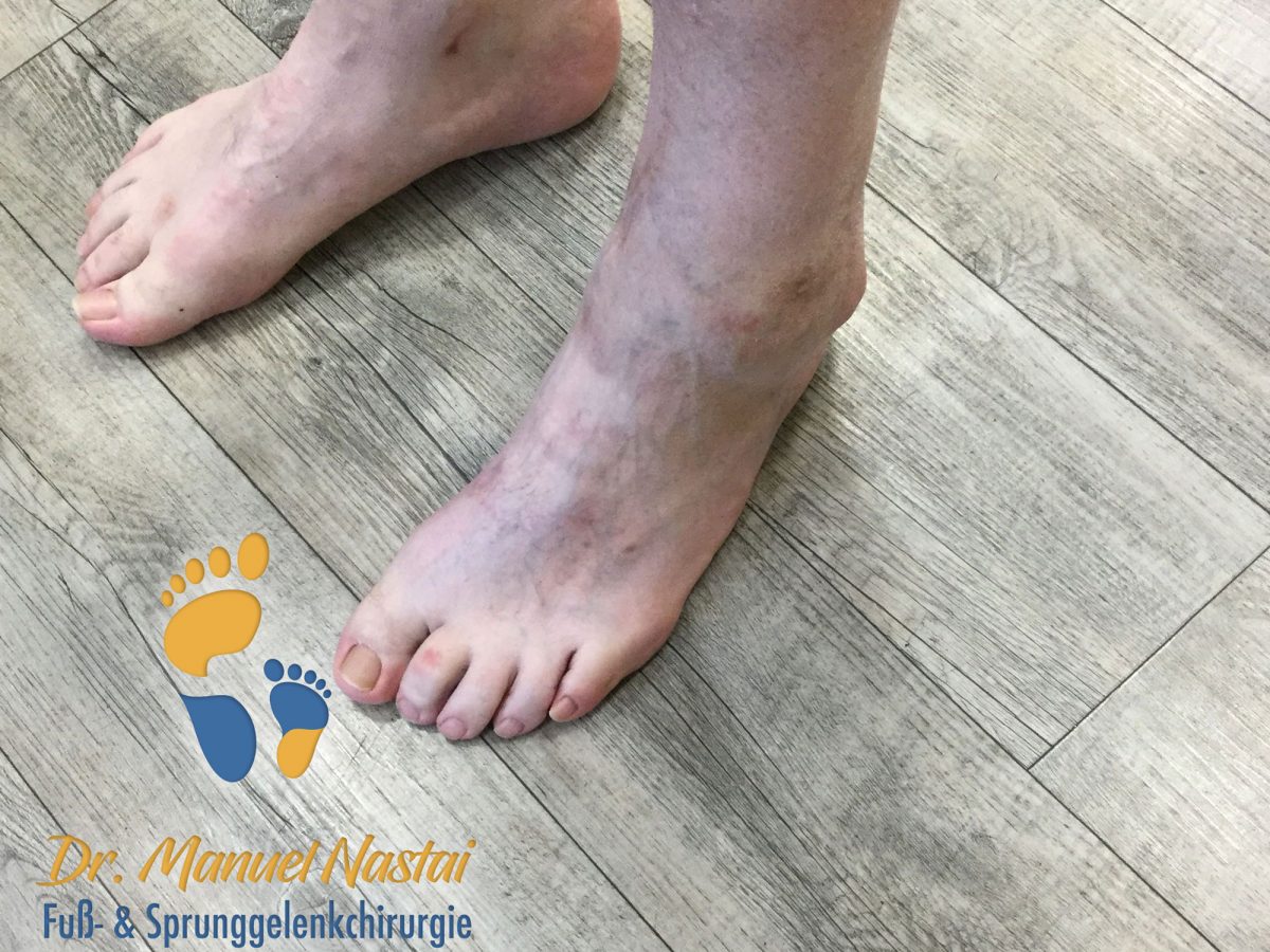 Posttraumatische OSG-Arthrose - Dr.-medic Manuel Nastai