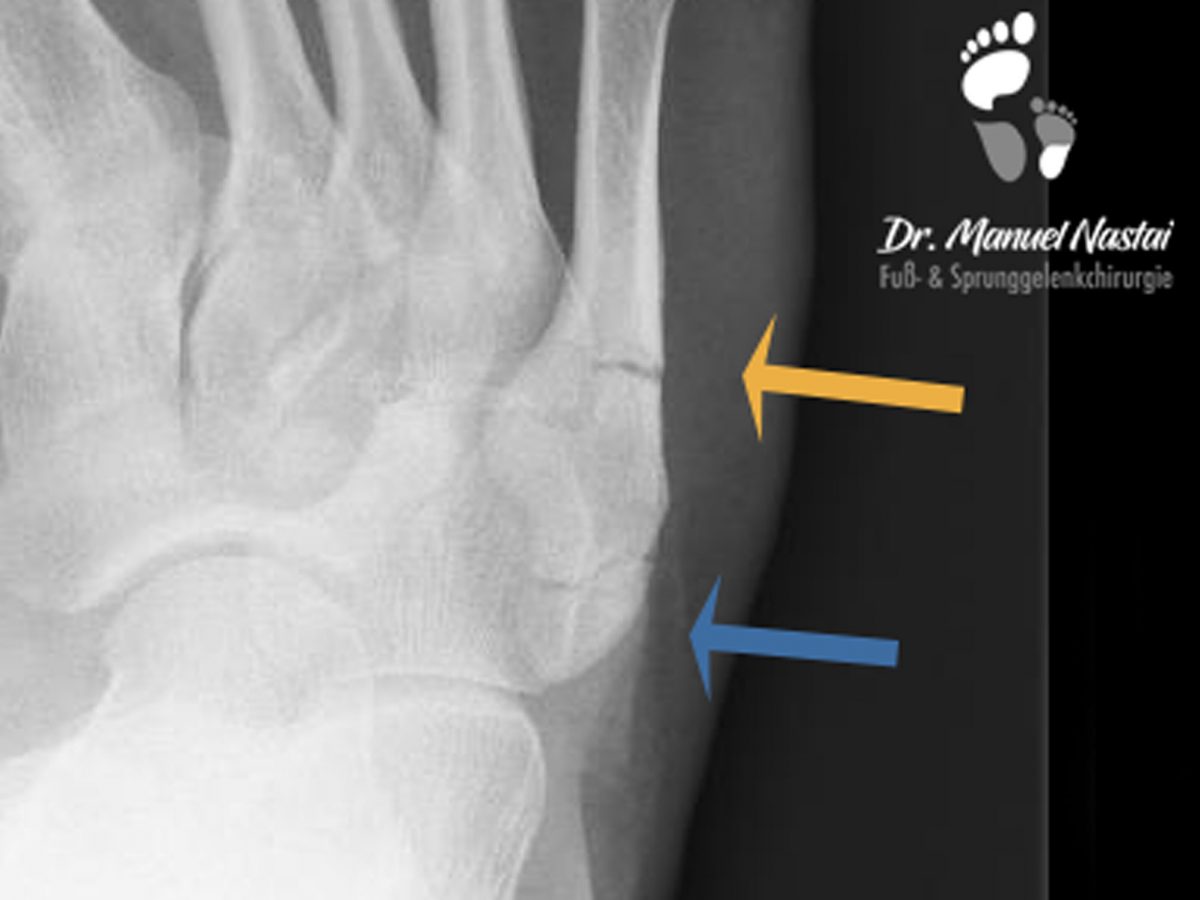 Jones-Fraktur bei Pes adductus - Dr.-medic Manuel Nastai
