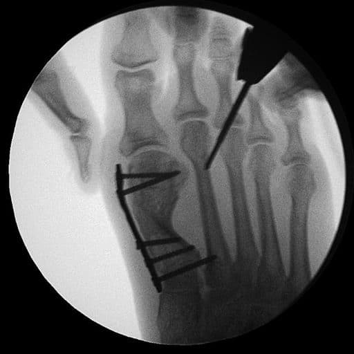 Distale Metaphysäre Metatarsale Osteotomie (DMMO) - Dr.-medic Manuel Nastai