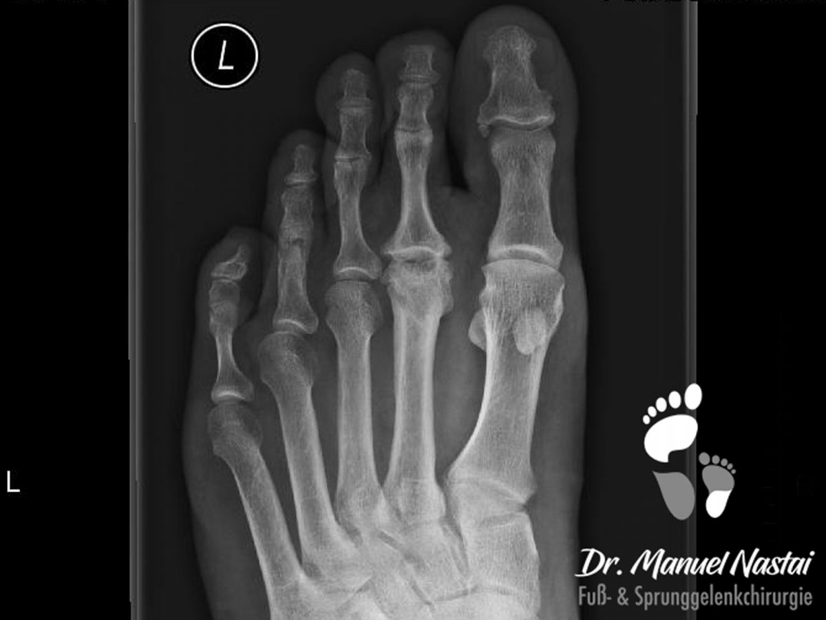 Metatarsale Köpfchenumstellungsosteotomie - Dr. M. Nastai
