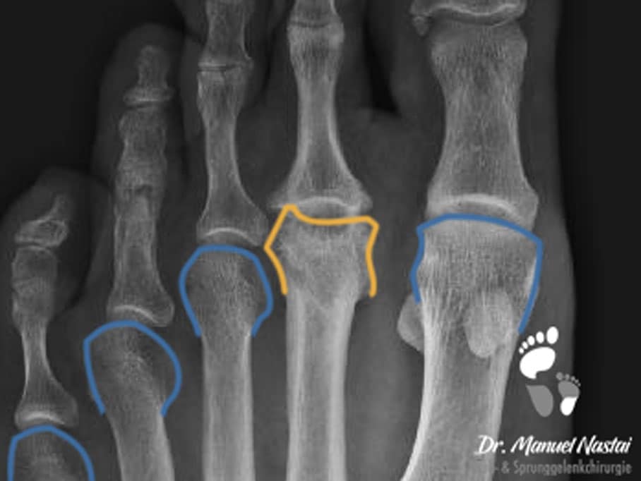 Aseptische Knochennekrose am Fuß - Dr.-medic Manuel Nastai