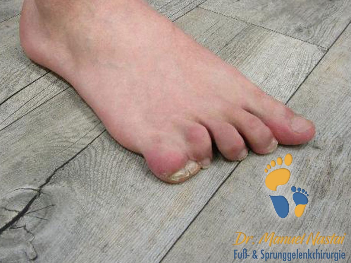 Polydaktylie | Überzählige Zehen - Dr.-medic Manuel Nastai