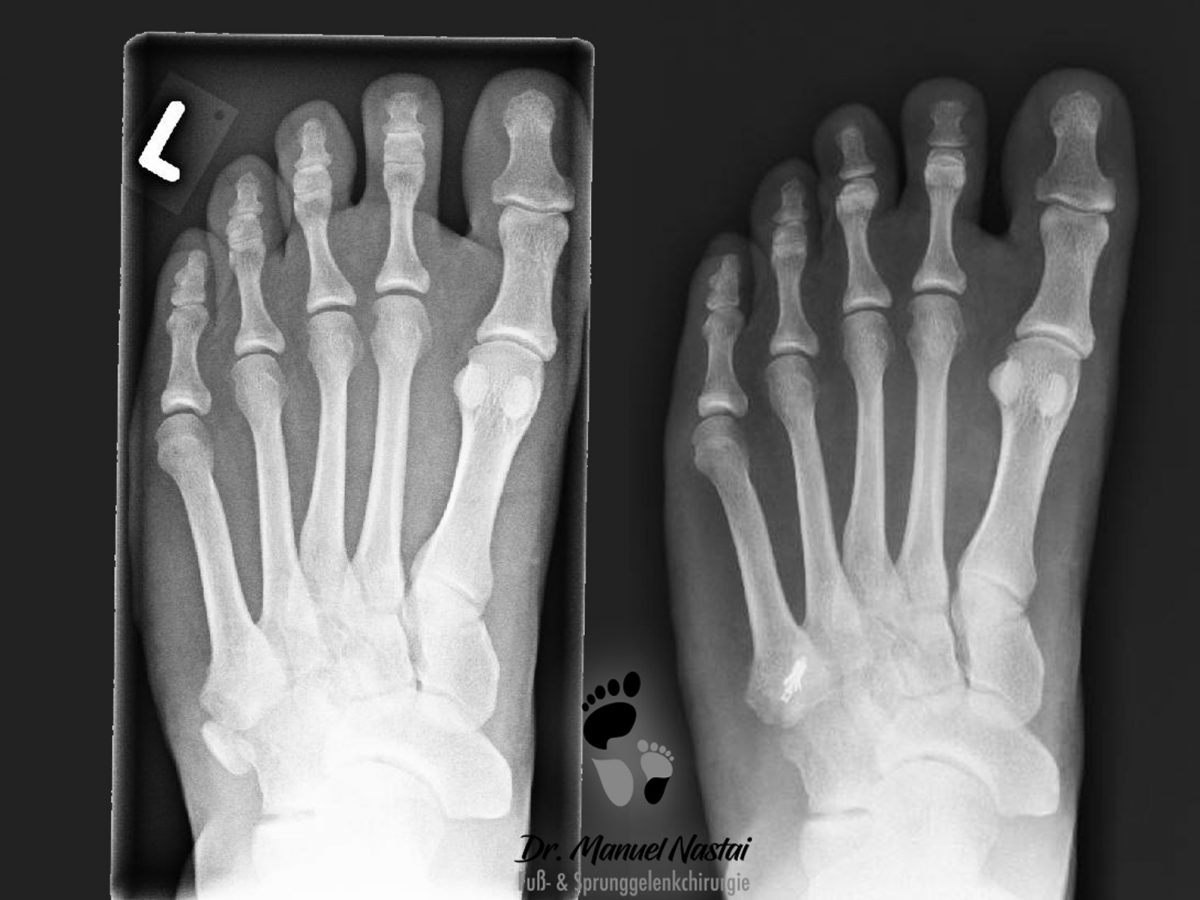 Os vesalianum Resektion - Dr.-medic Manuel Nastai