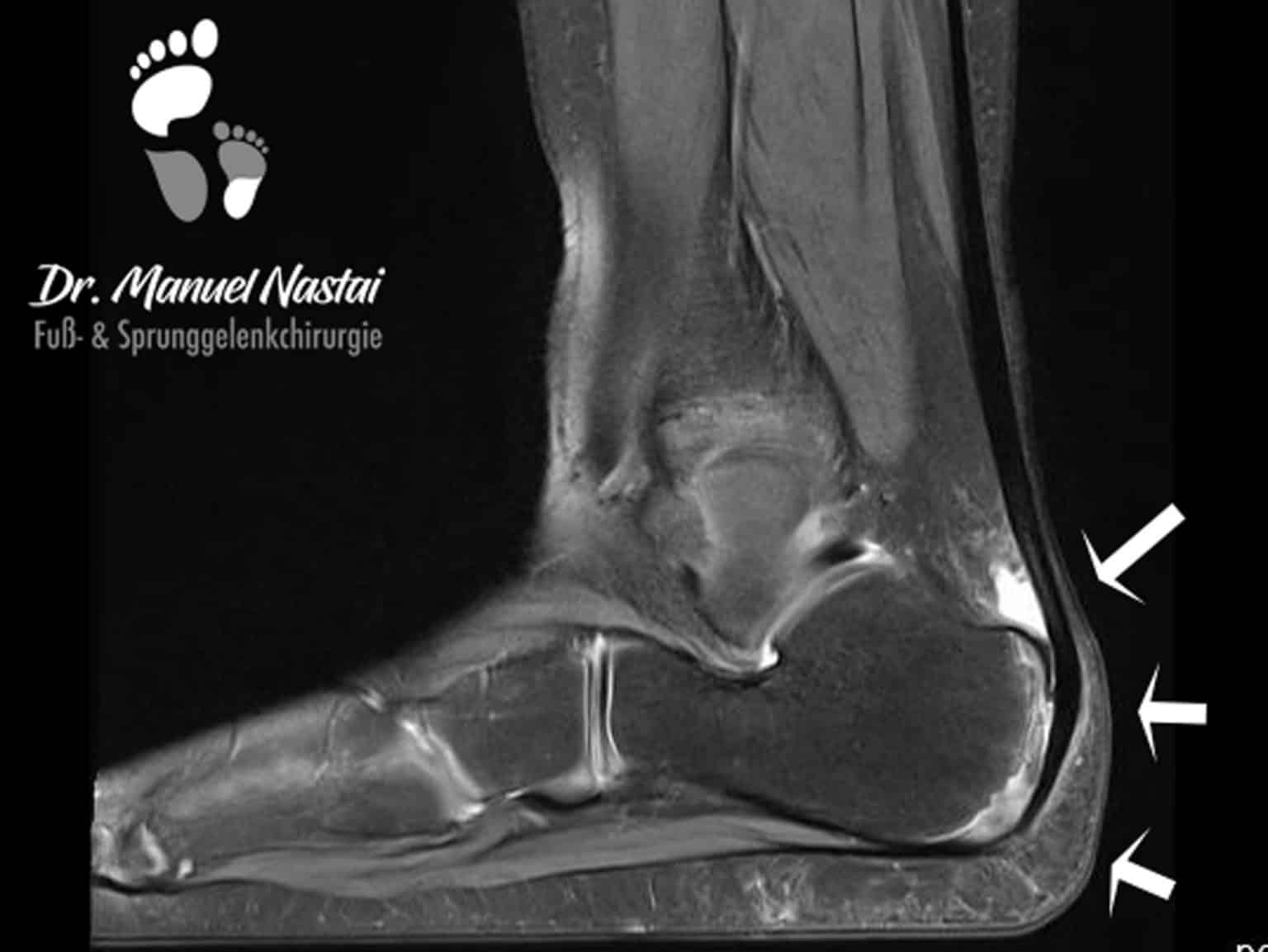 Morbus Haglund-Sever (Apophysitis calcanei)