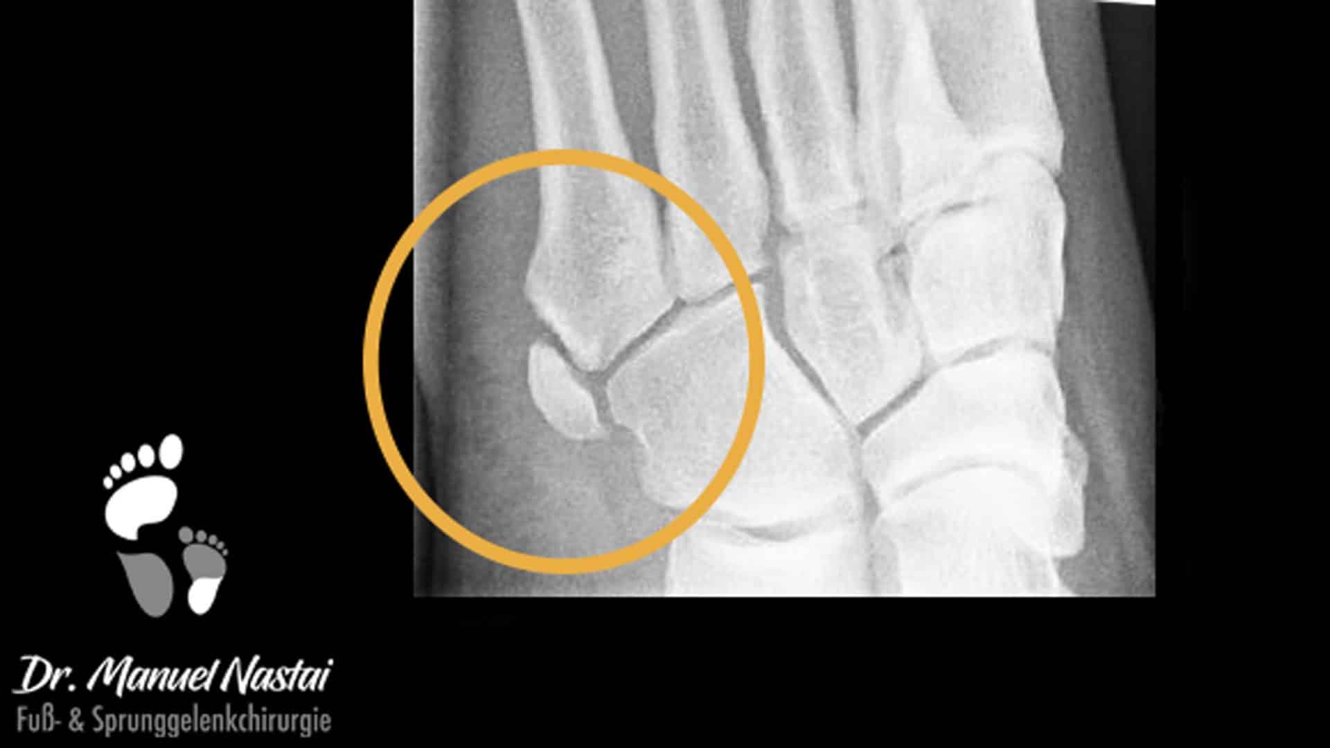 Os vesalianum Resektion - Dr.-medic Manuel Nastai