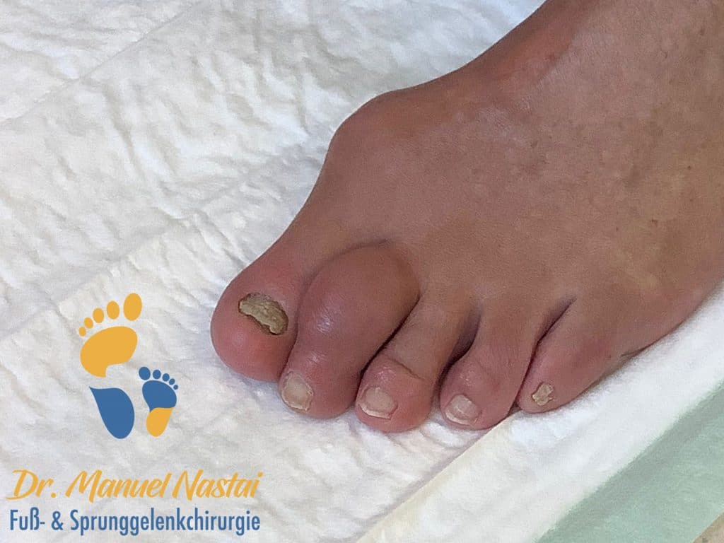 Gicht am Zeh - Ursachen, Symptome und Behandlung