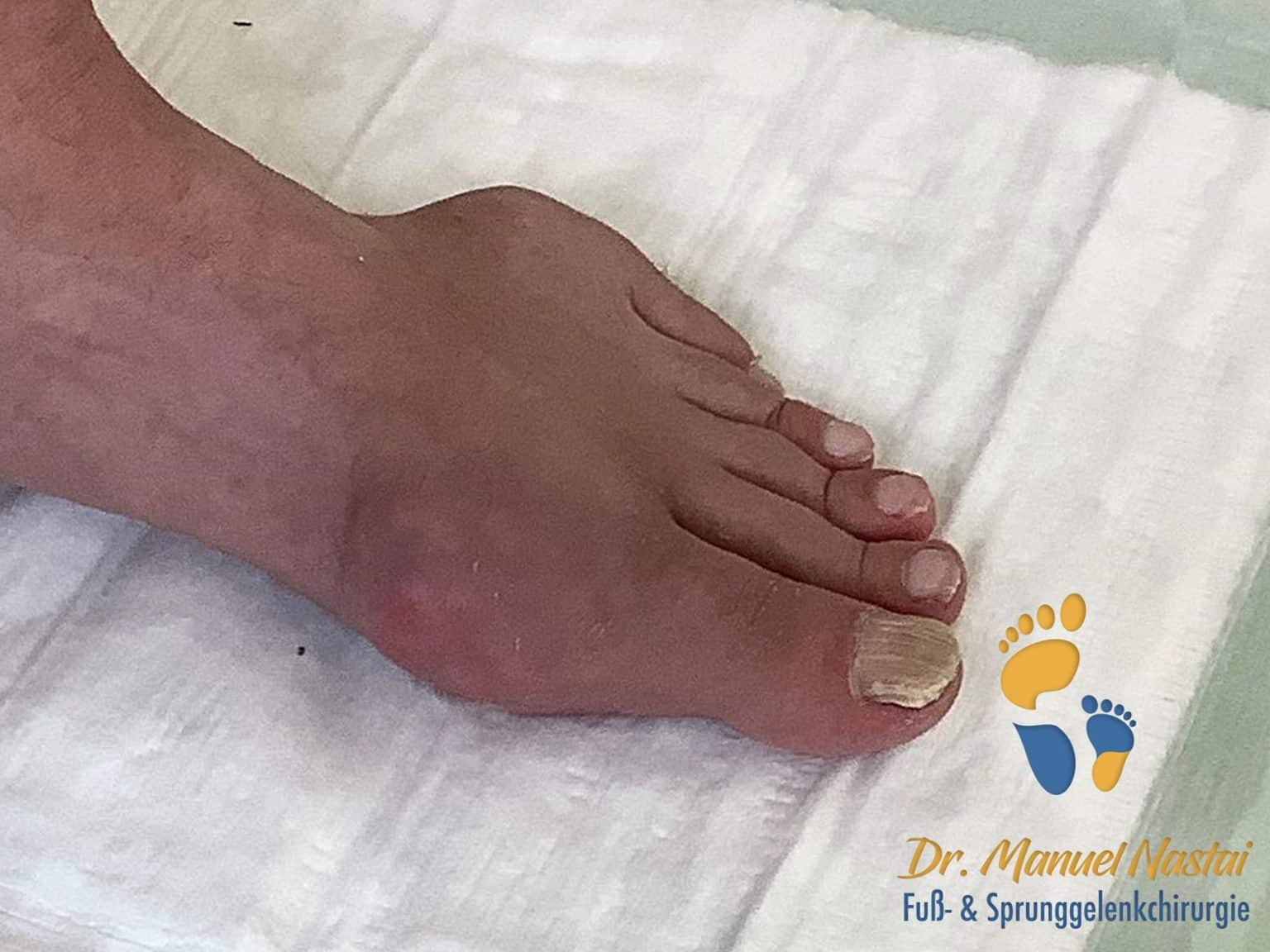 Gicht am Zeh - Ursachen, Symptome und Behandlung