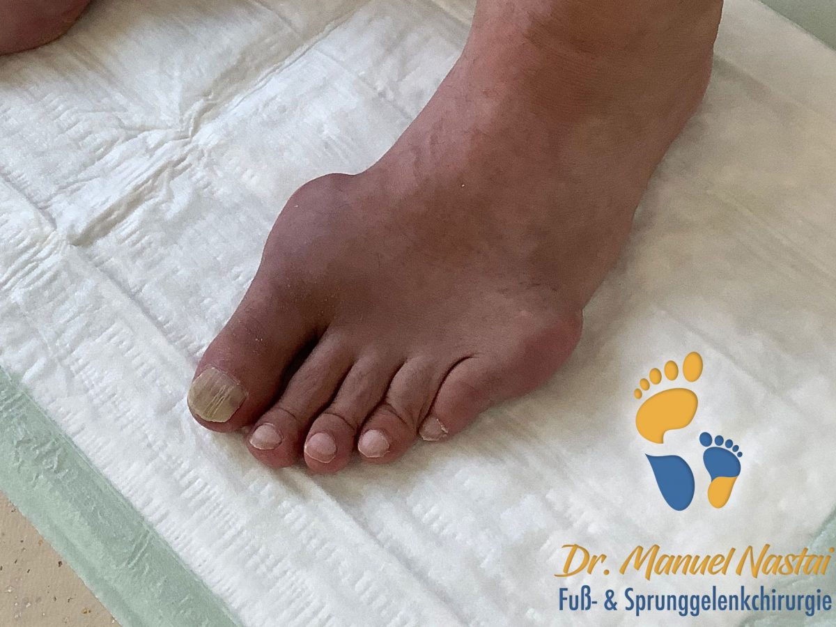 Gicht am Zeh - Ursachen, Symptome und Behandlung