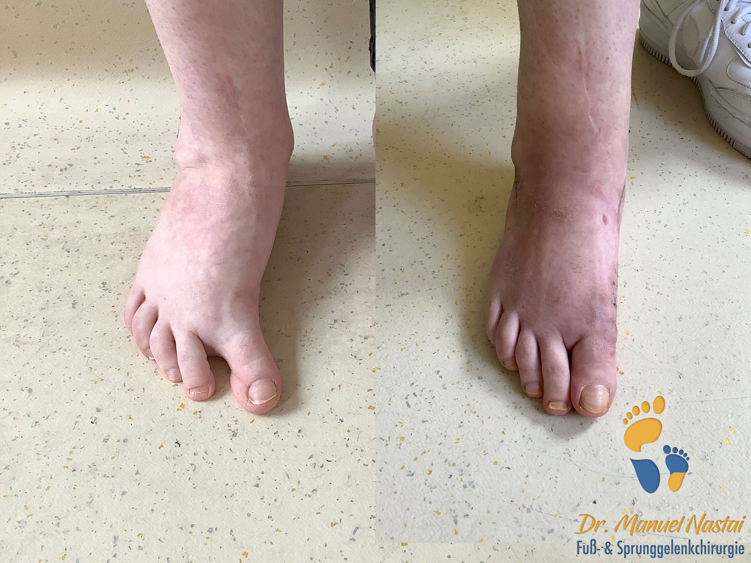 Hallux varus Operation