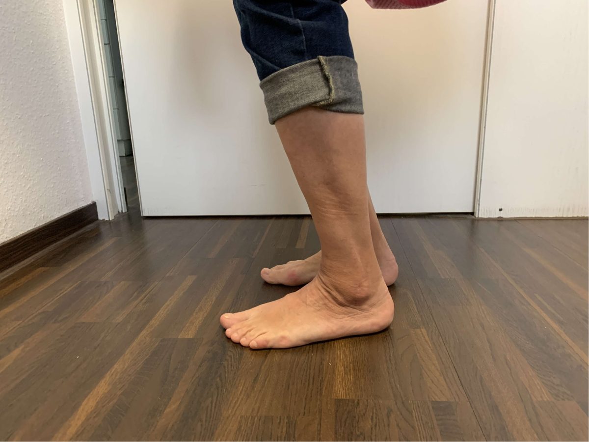 Minimalinvasive Zadek Osteotomie bei Haglund Exostose