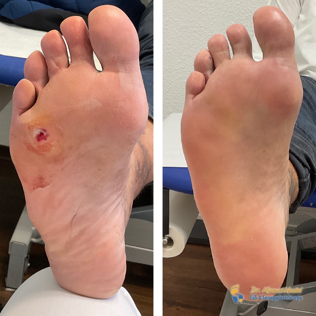 Minimalinvasiver Eingriff für Malum Perforans - Dr.-medic Manuel Nastai