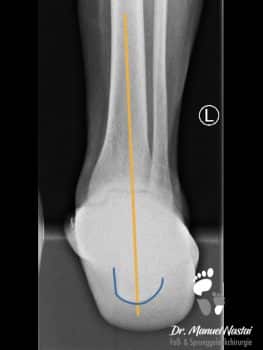 Der Plattfuß | Pes planovalgus - Dr.-medic Manuel Nastai | Fußchirurgie